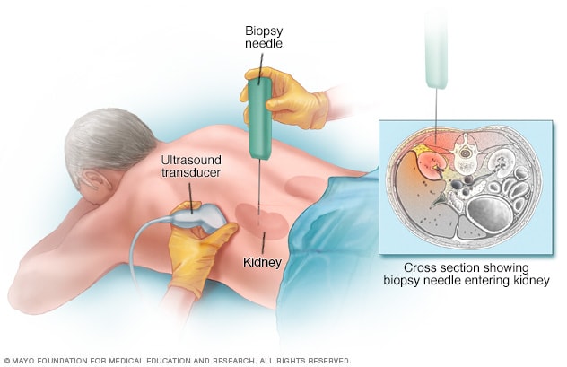 Is there a cure for nephropathy?