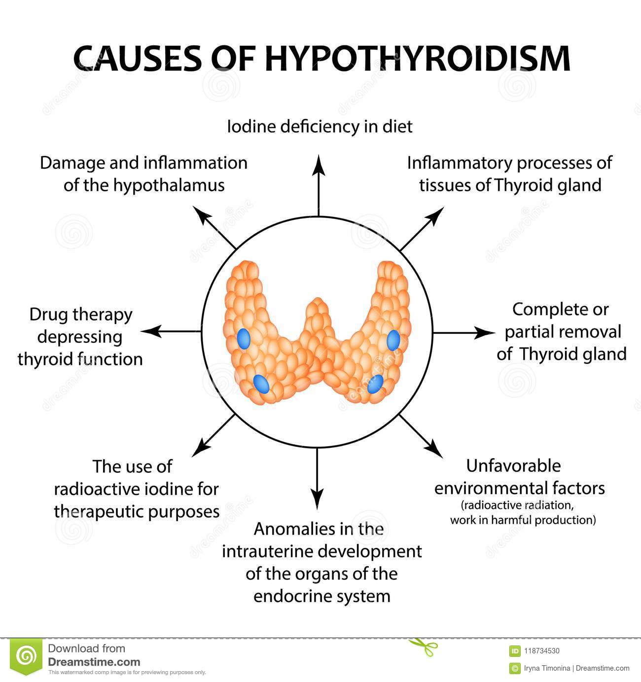What are 4 major causes of hypothyroidism?