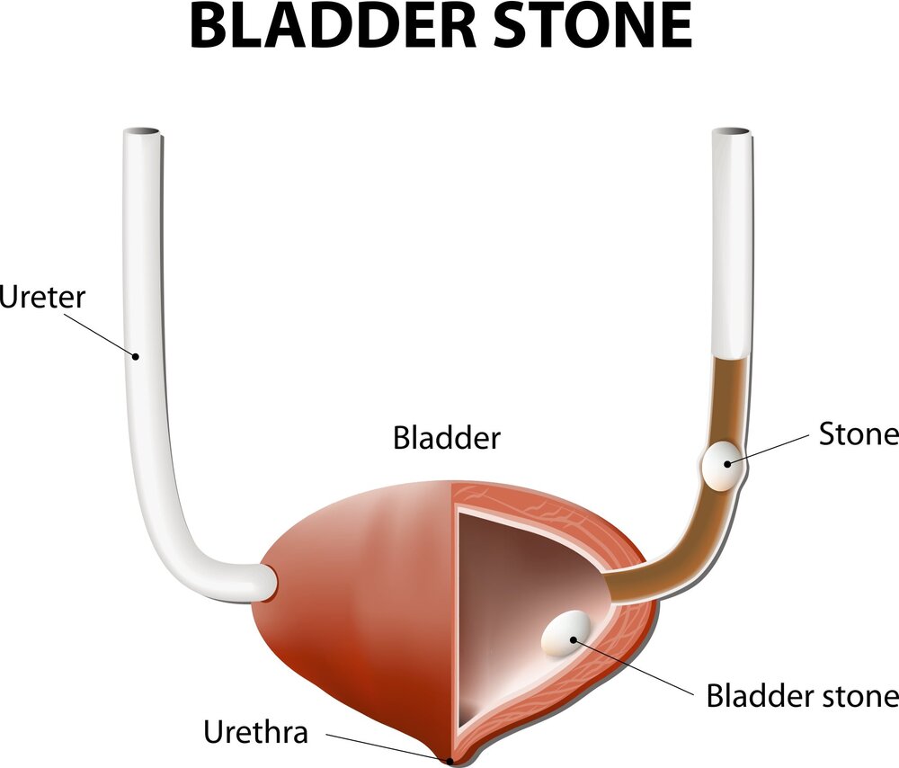 What are bladder stones and what causes them?