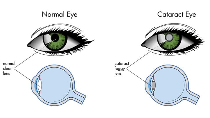 What are cataracts made of?