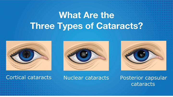 What are the 3 types of cataracts?