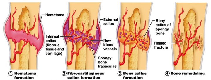 What are the 4 stages of bone healing?