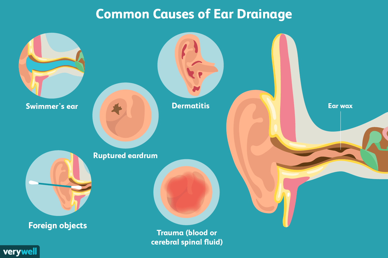 What are the signs and symptoms of fluid loss from drainage?