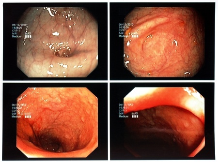 What are the signs of a perforated bowel after colonoscopy?