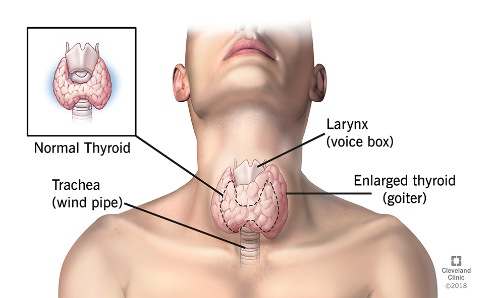 What are the symptoms of an inflamed thyroid?