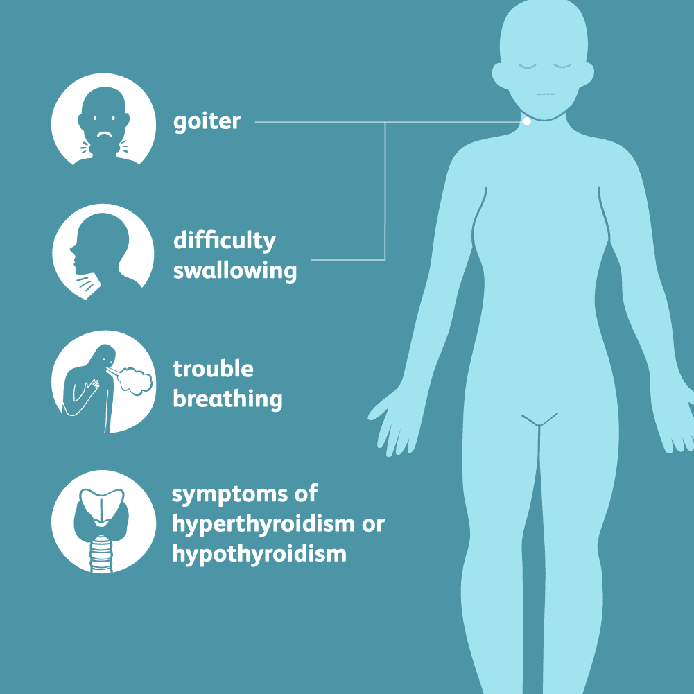 What are the symptoms of iodine toxicity?