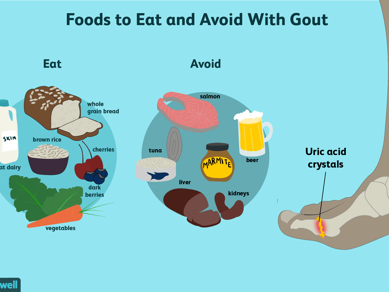 What are the top five foods that cause gout?