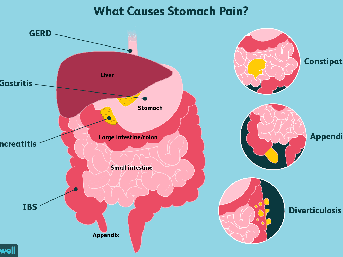 What are the types of stomach pain?