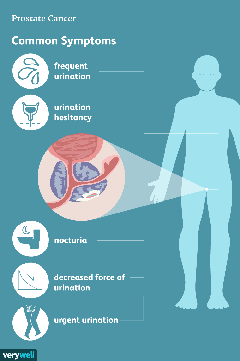 What are the urinary symptoms of prostate problems?