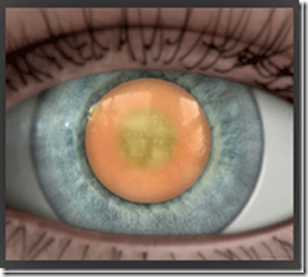 What are the warning signs of cataracts?