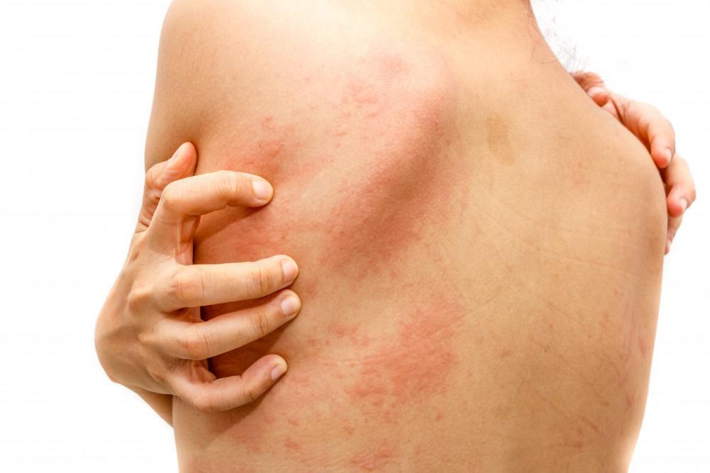 What can cause a sudden allergic reaction?