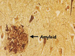 What causes brain plaque buildup?