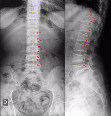 What causes fish vertebrae?