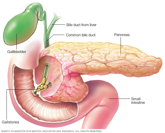 What causes inflammation of the pancreas?