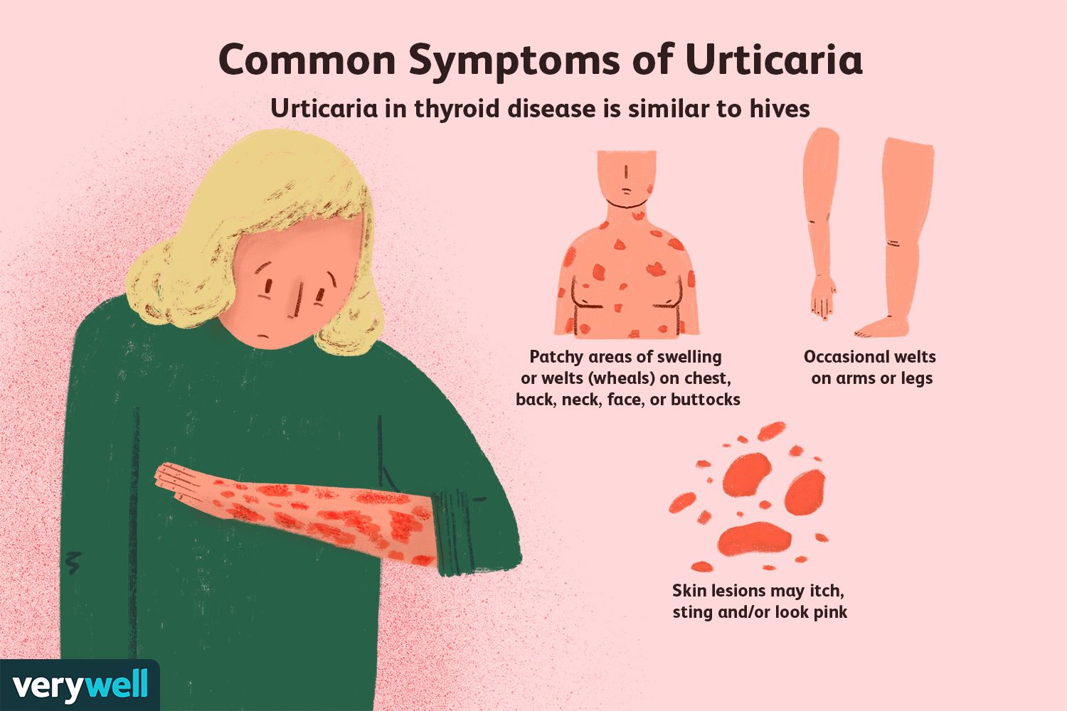 What causes thyroid to flare up?