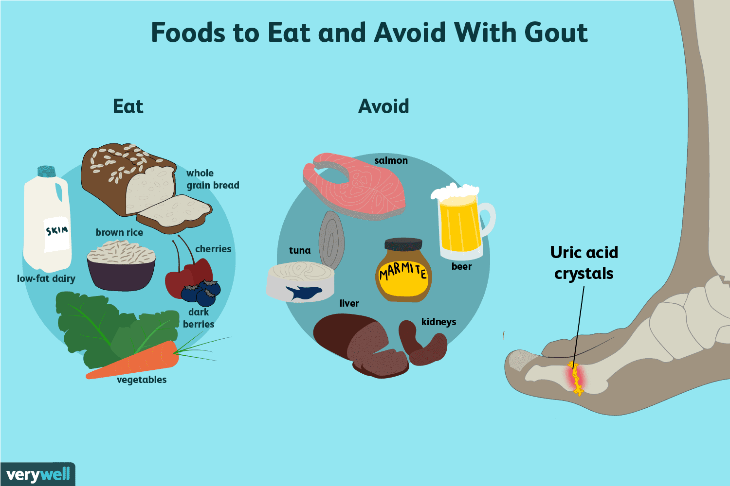 What clears up gout fast?