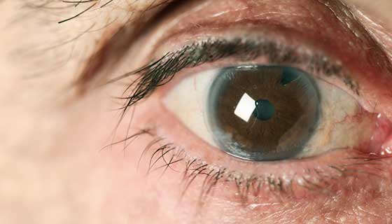 What does a cataract look like on your eye?