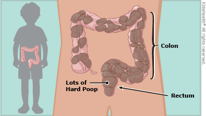 What does being constipated do to your body?