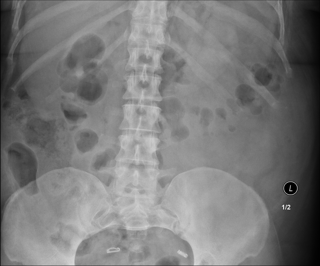 What does bowel gas look like on xray?