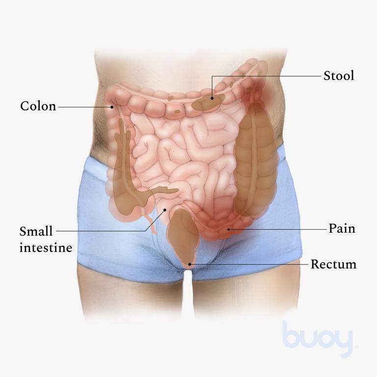 What does constipation stomach feel like?