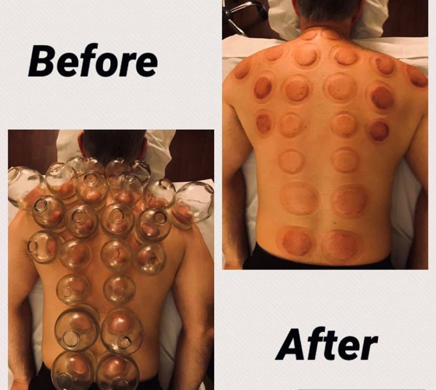 What does cupping does to your body?