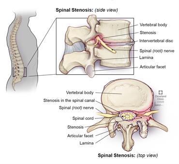 What does stenosis mean in medical terms?
