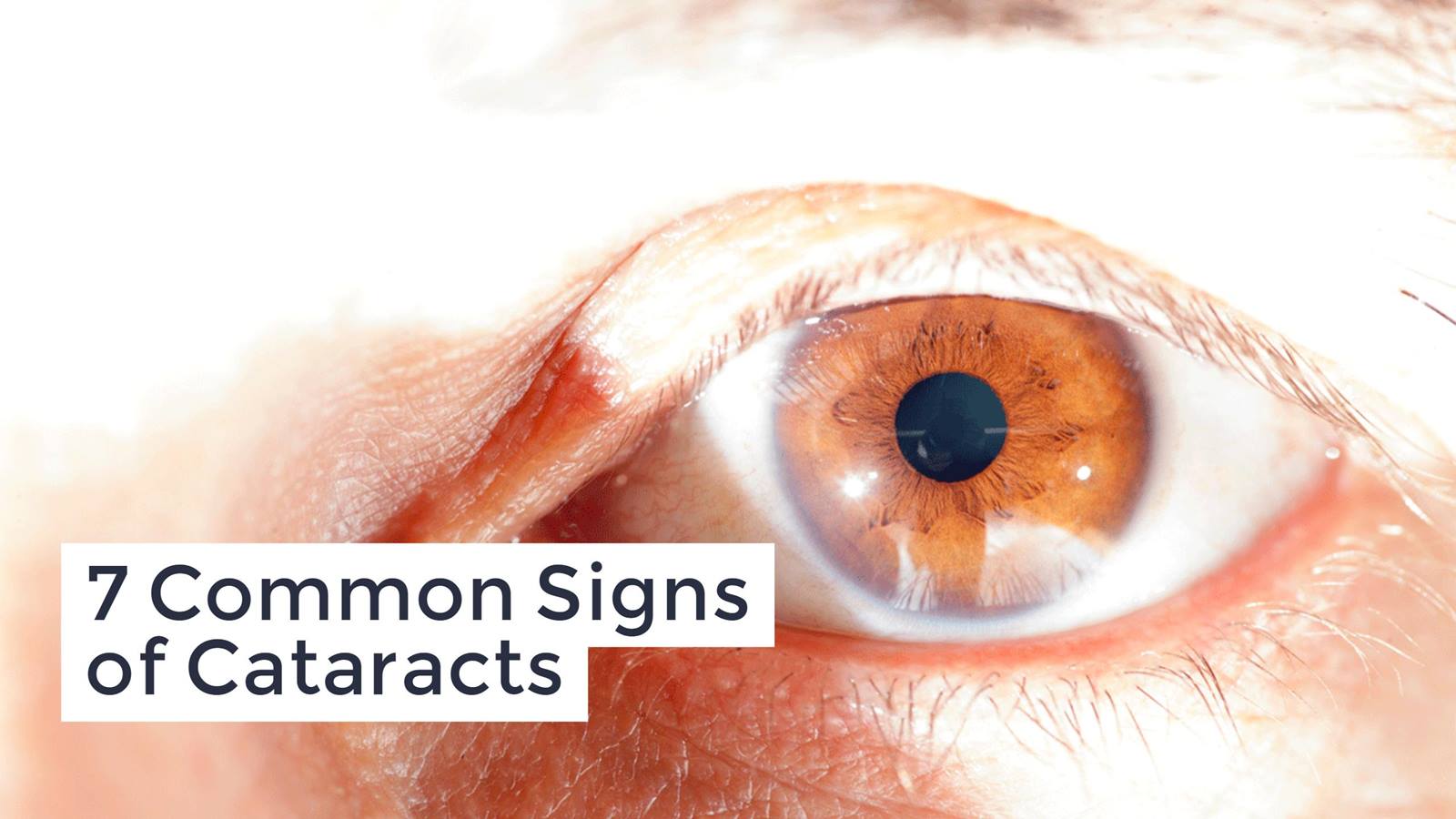 What does the start of cataracts look like?