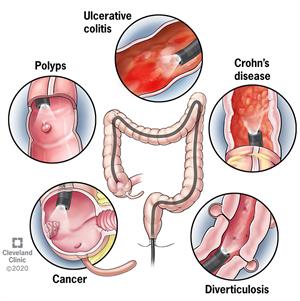 What exactly happens during a colonoscopy?