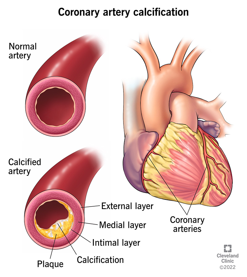 What food causes calcium buildup in arteries?