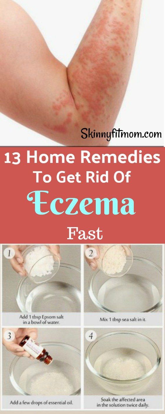 What gets rid of eczema fast?