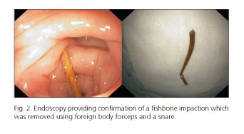 What happens if fish bone goes inside stomach?