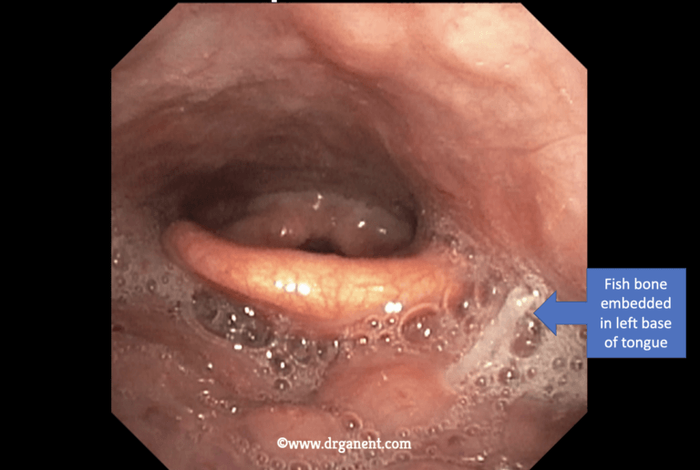 What happens if fish bone remain stuck in throat?