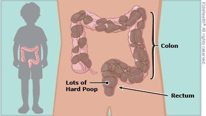 What happens if you are constipated for too long?