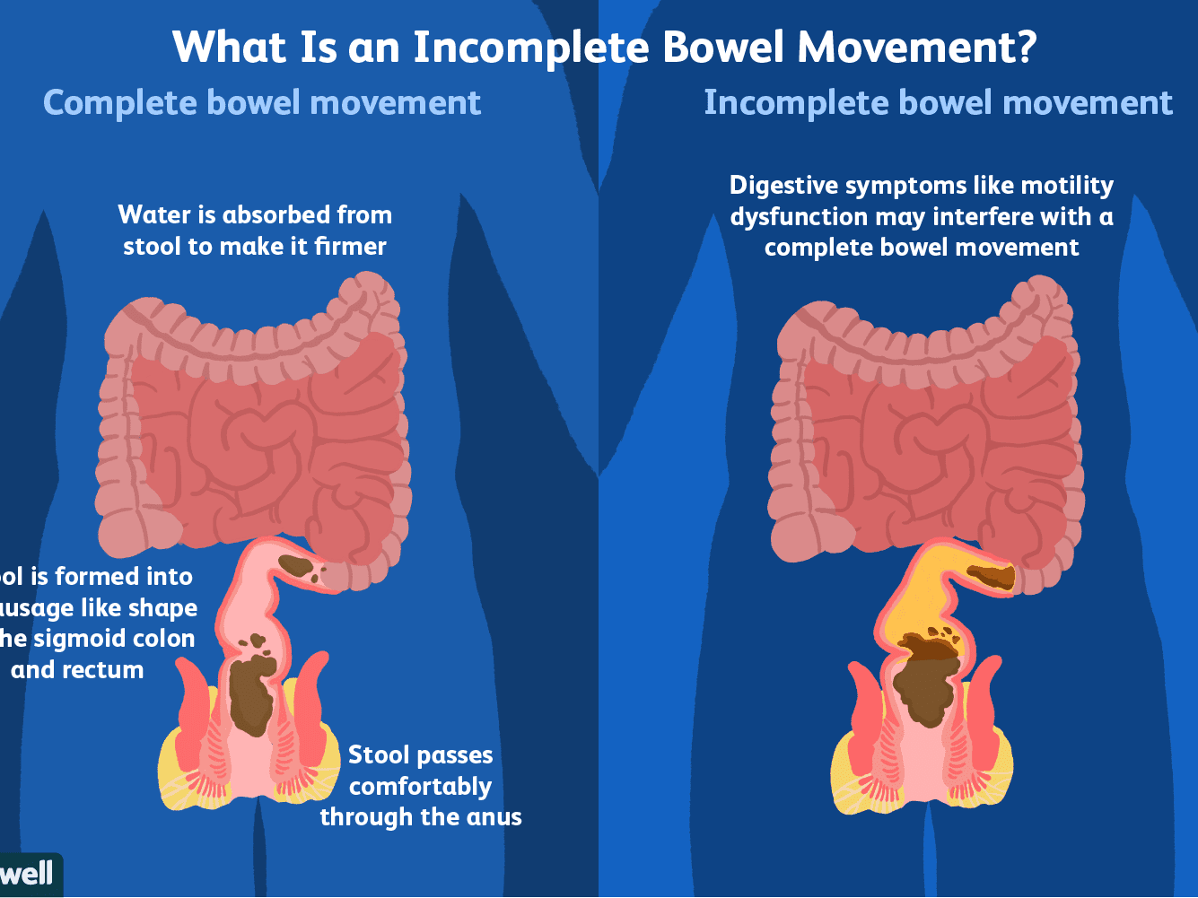 What happens if you are constipated too long?