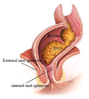 What happens when you have bowel leakage?