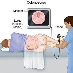 What helps with trapped wind after colonoscopy?