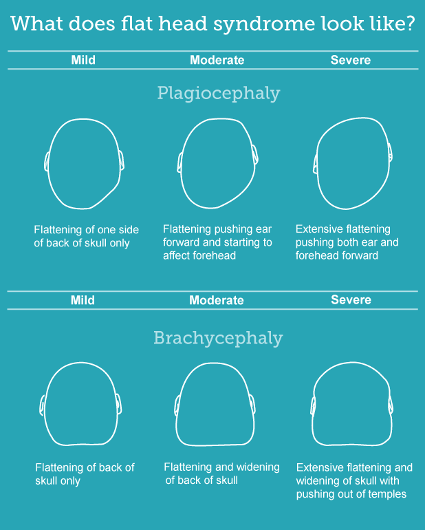 What is another name for flat head?