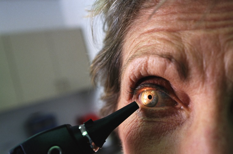 What is the average age to develop cataracts?