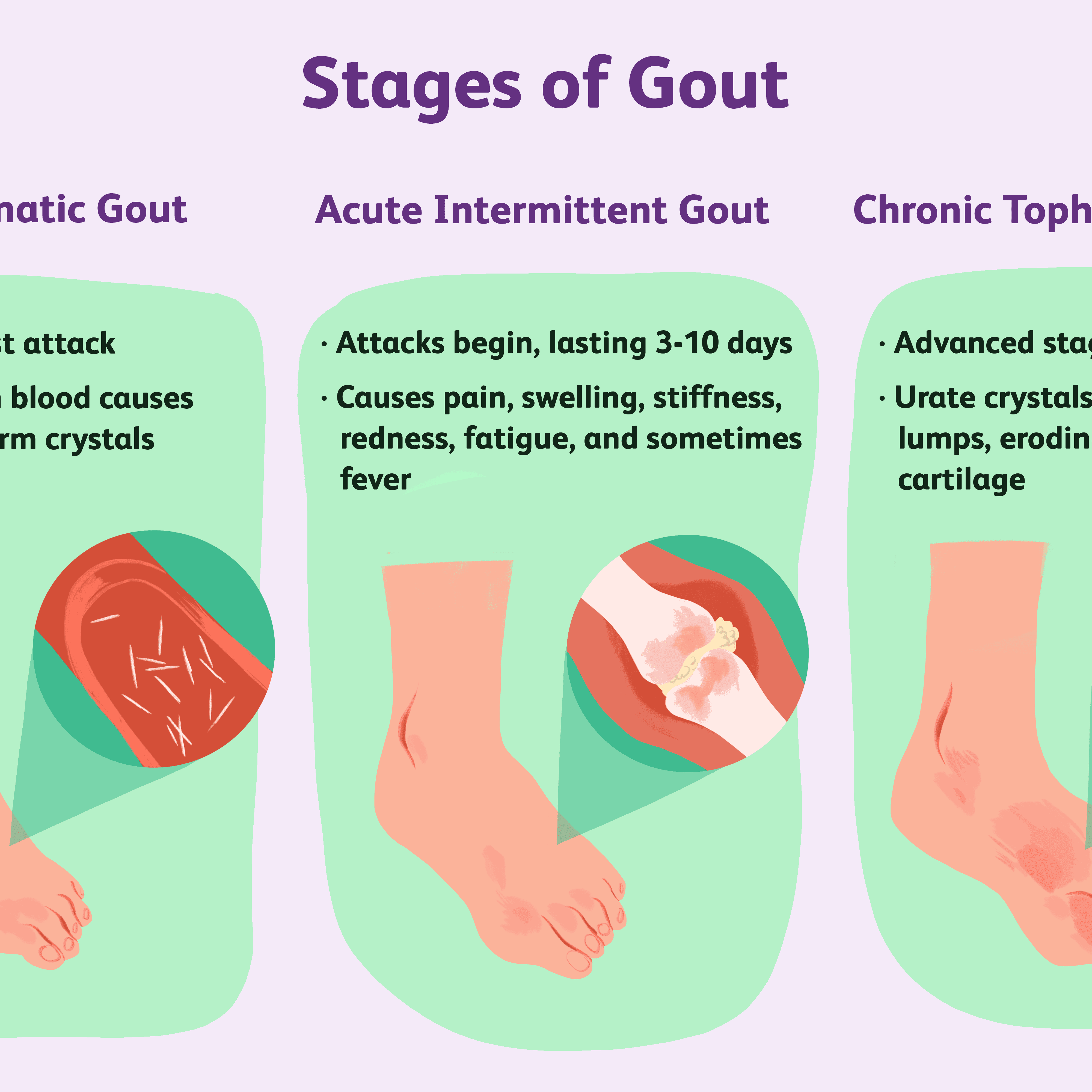 What is the cause of gout?