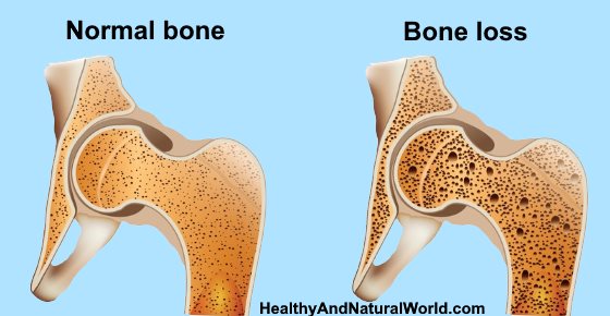 What is the fastest way to increase bone density?