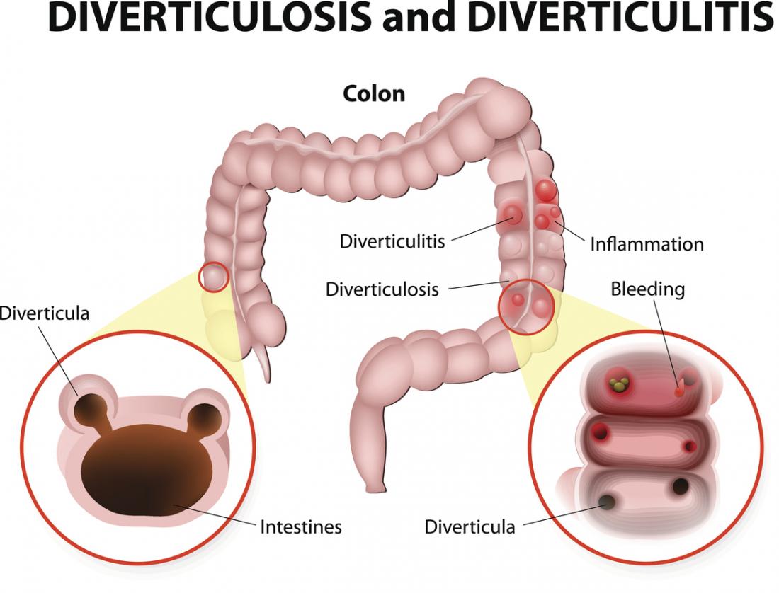 What is the main cause of diverticulosis?