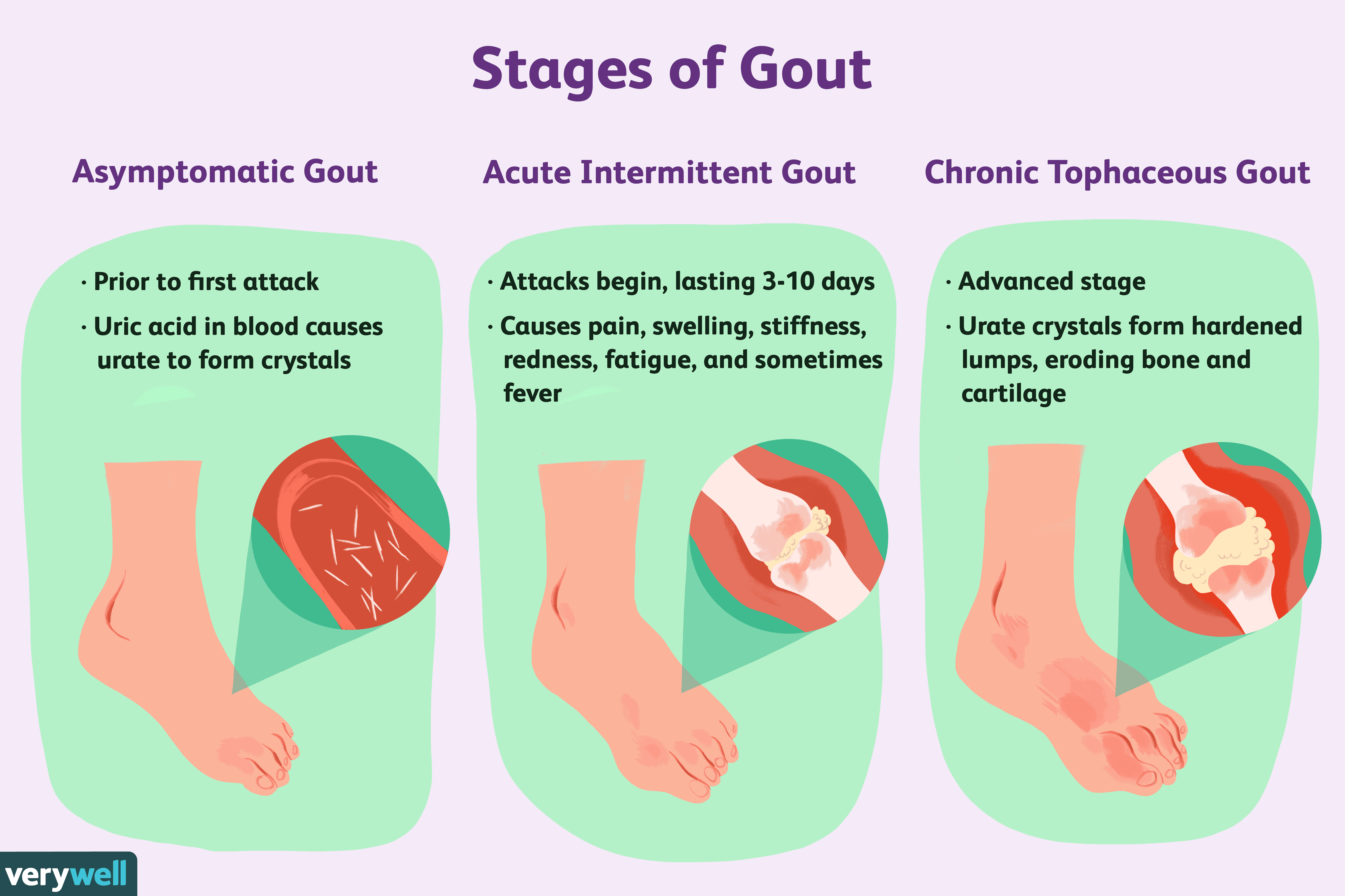 What is the major cause of gout?
