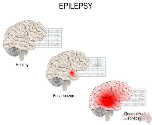 What is the root of epilepsy?