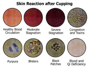 What should you not do after cupping?