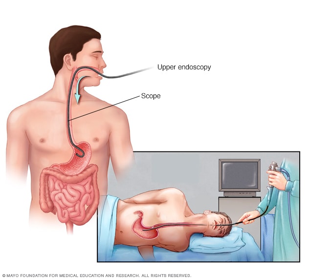 What should you watch after an endoscopy?