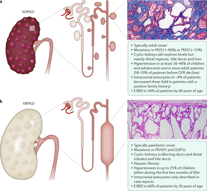 What structures are affected by polycystic kidney disease?