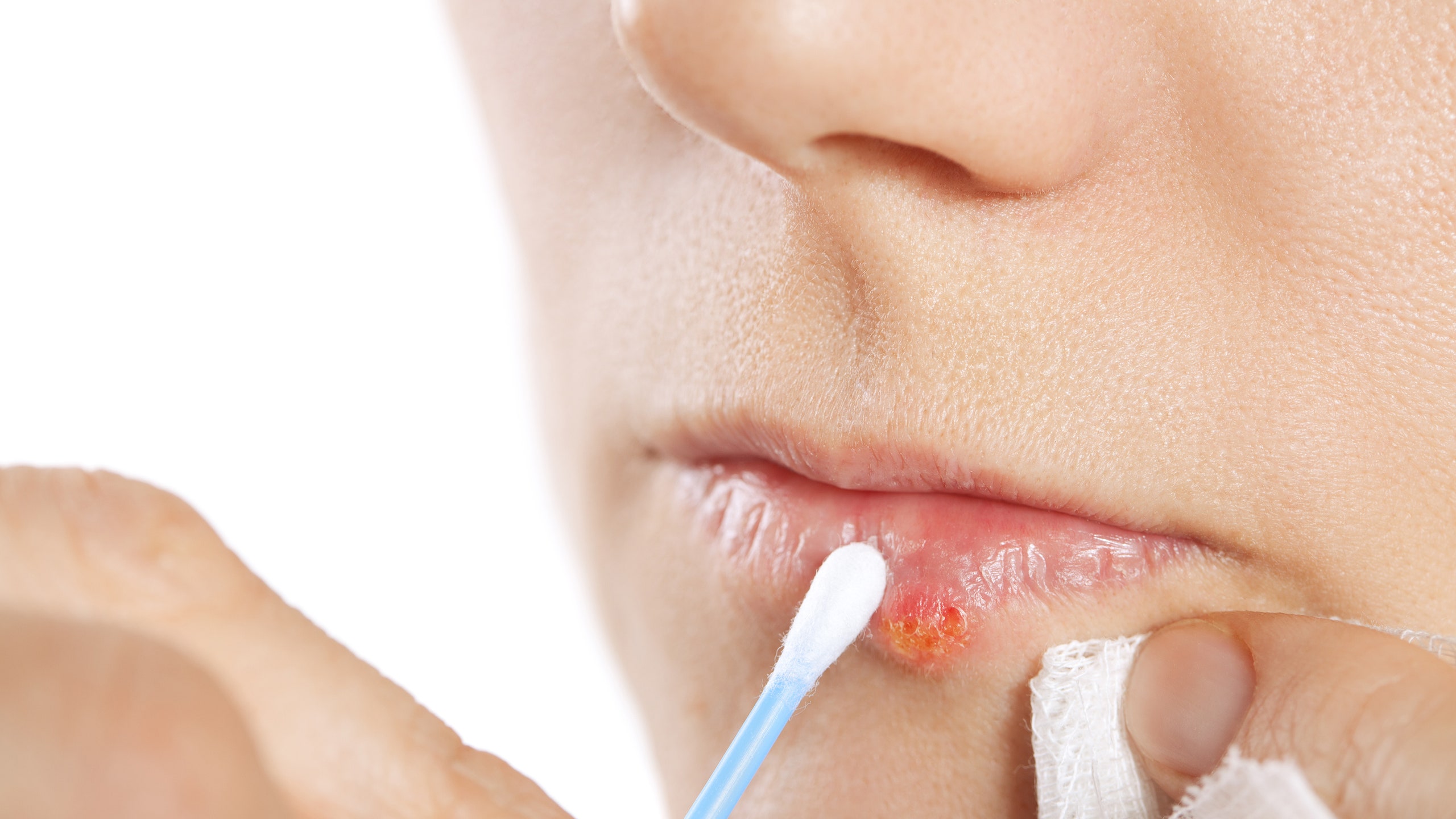 What to avoid doing with a cold sore?
