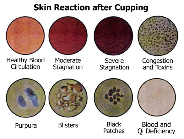What to expect after cupping?