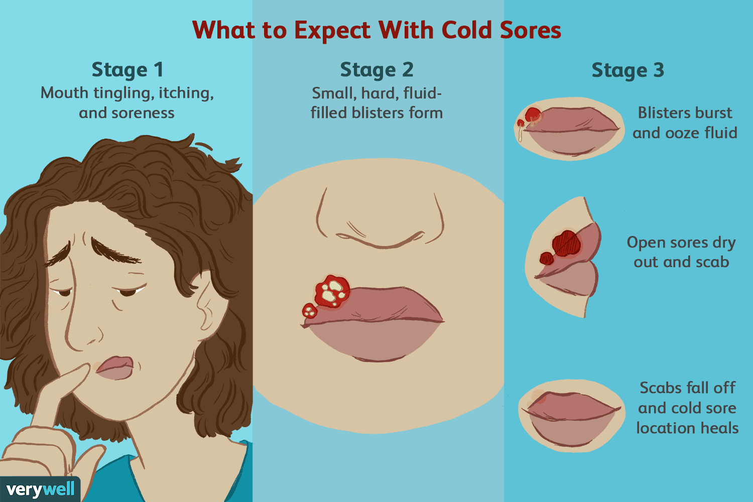 What triggers a cold sore?