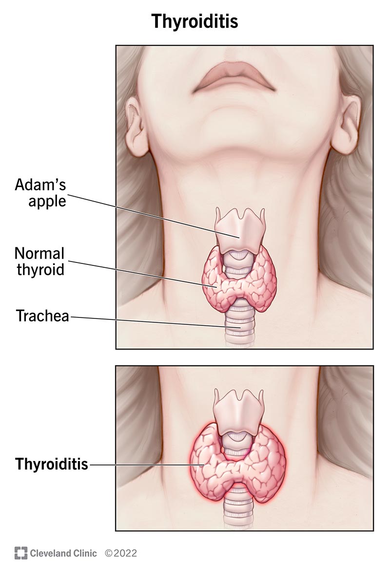 What triggers thyroid inflammation?